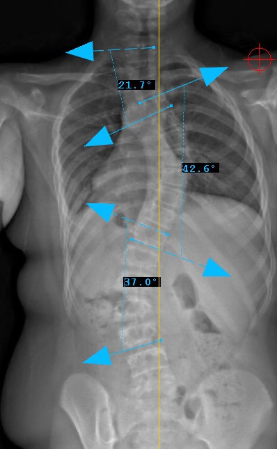 Lenke Class 1CN – Harms Study Group