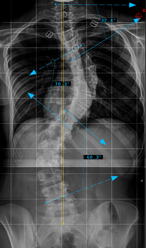 Lenke Class 2C+ – Harms Study Group