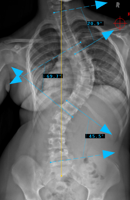 Lenke Class 3A- – Harms Study Group