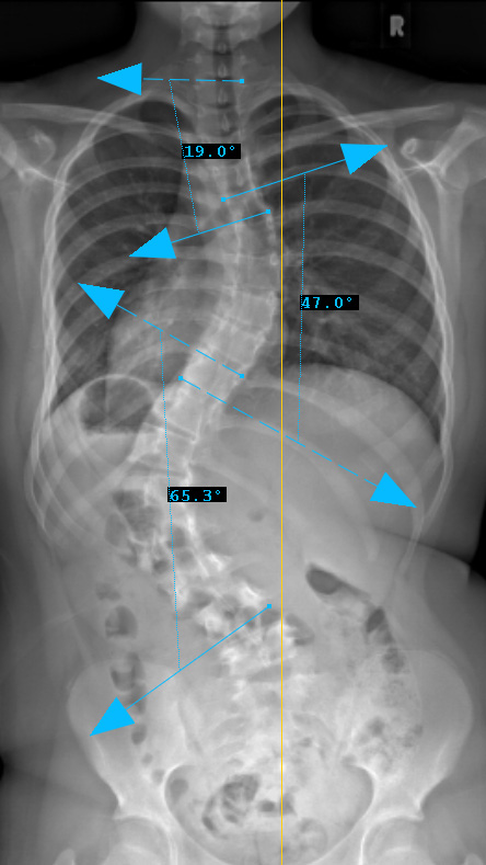 Lenke Class 6CN – Harms Study Group