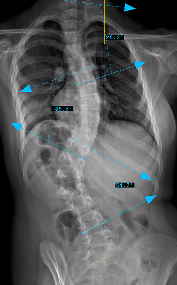 Lenke Class 6C+ – Harms Study Group