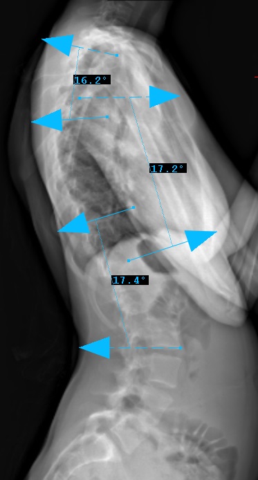 Lenke Class 1BN – Harms Study Group