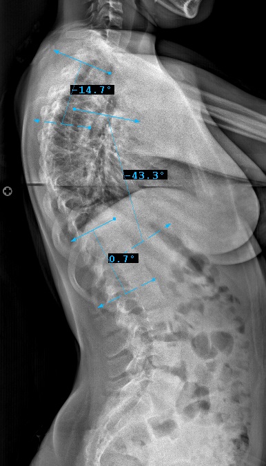 Lenke Class 1B+ – Harms Study Group