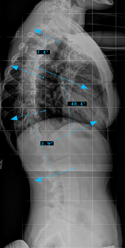Lenke Class 2C+ – Harms Study Group