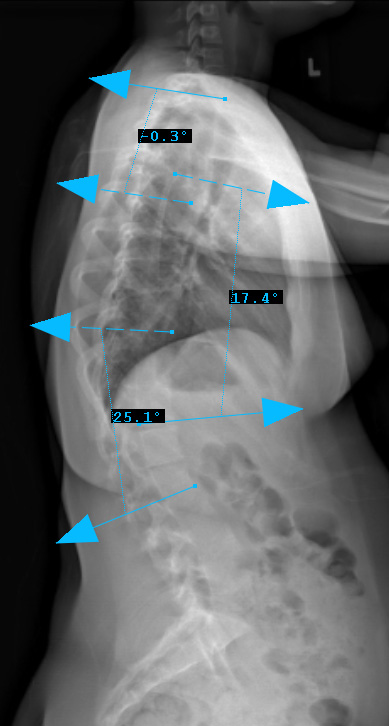 Lenke Class 6CN – Harms Study Group