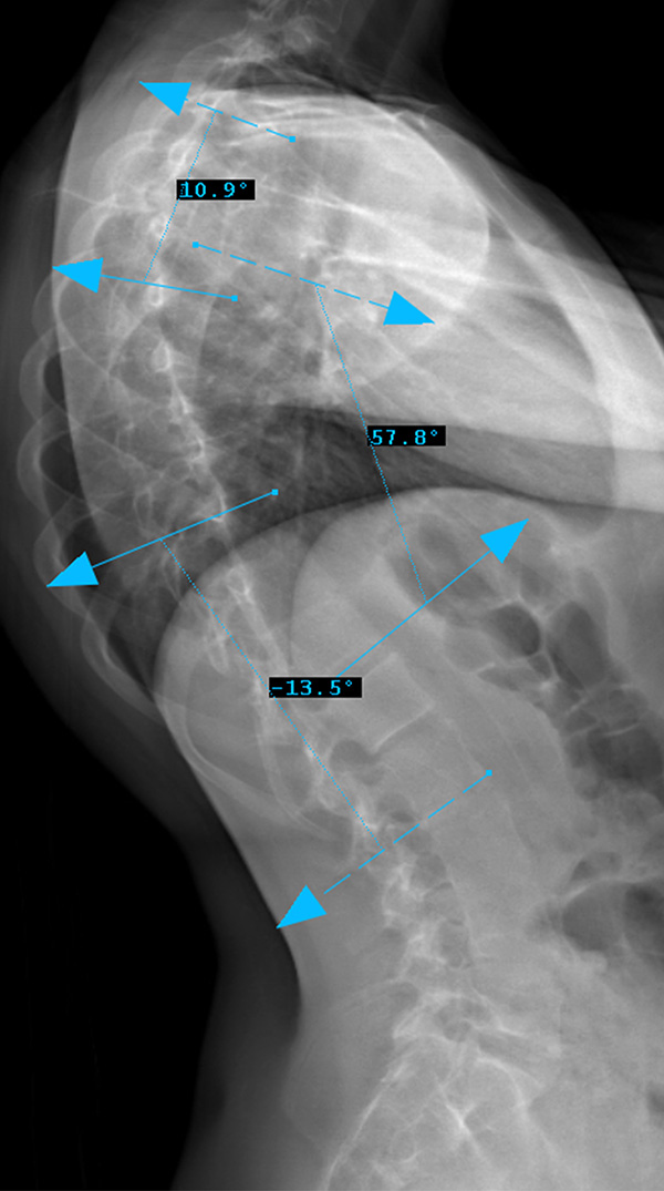 Lenke Class 6C+ – Harms Study Group