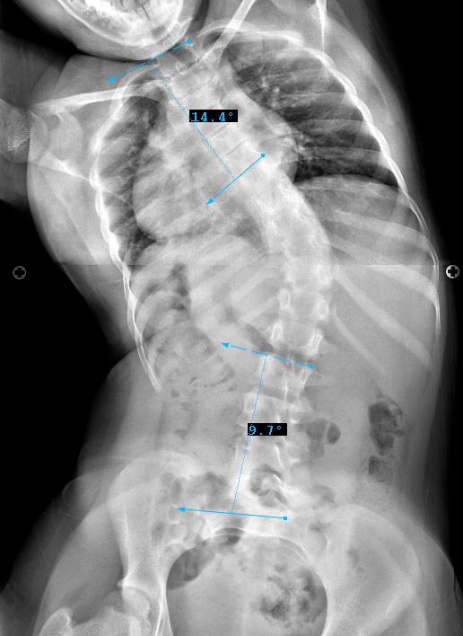 Lenke Class 1B+ – Harms Study Group