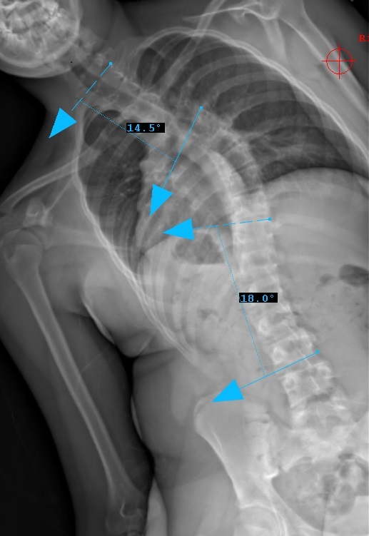 Lenke Class 1C+ – Harms Study Group