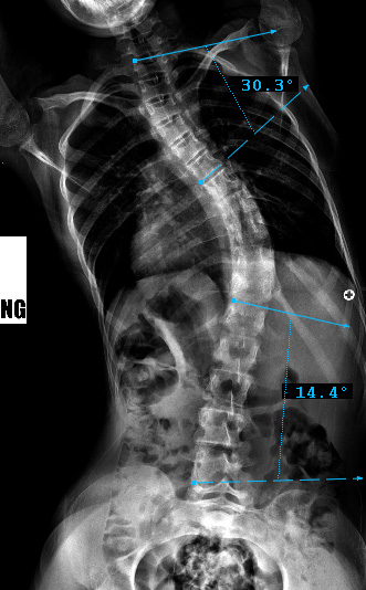 Lenke Class 2A+ – Harms Study Group