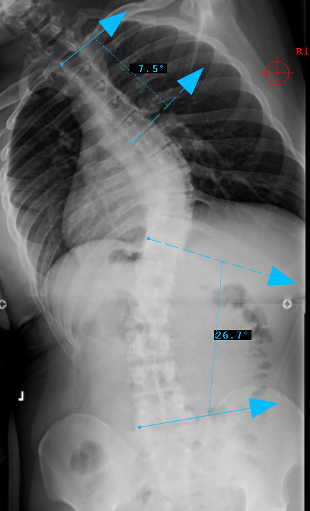 Lenke Class 3CN – Harms Study Group