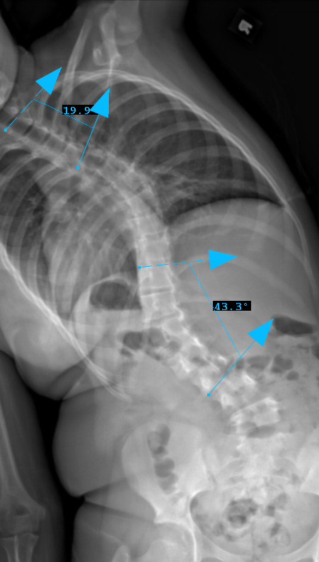 Lenke Class 6CN – Harms Study Group