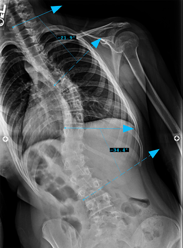 Lenke Class 6C+ – Harms Study Group