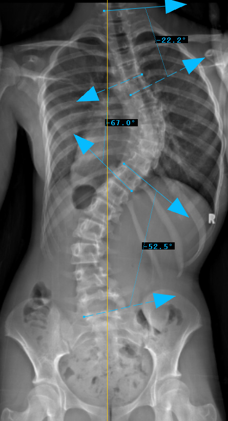 Lenke Class 3CN – Harms Study Group
