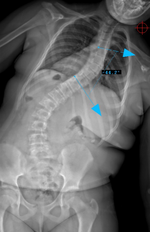 Lenke Class 1CN – Harms Study Group