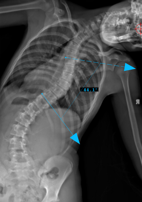 Lenke Class 2B- – Harms Study Group