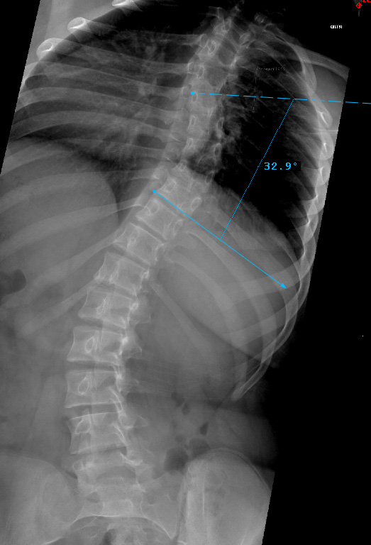 Lenke Class 2C- – Harms Study Group