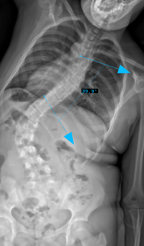Lenke Class 6CN – Harms Study Group