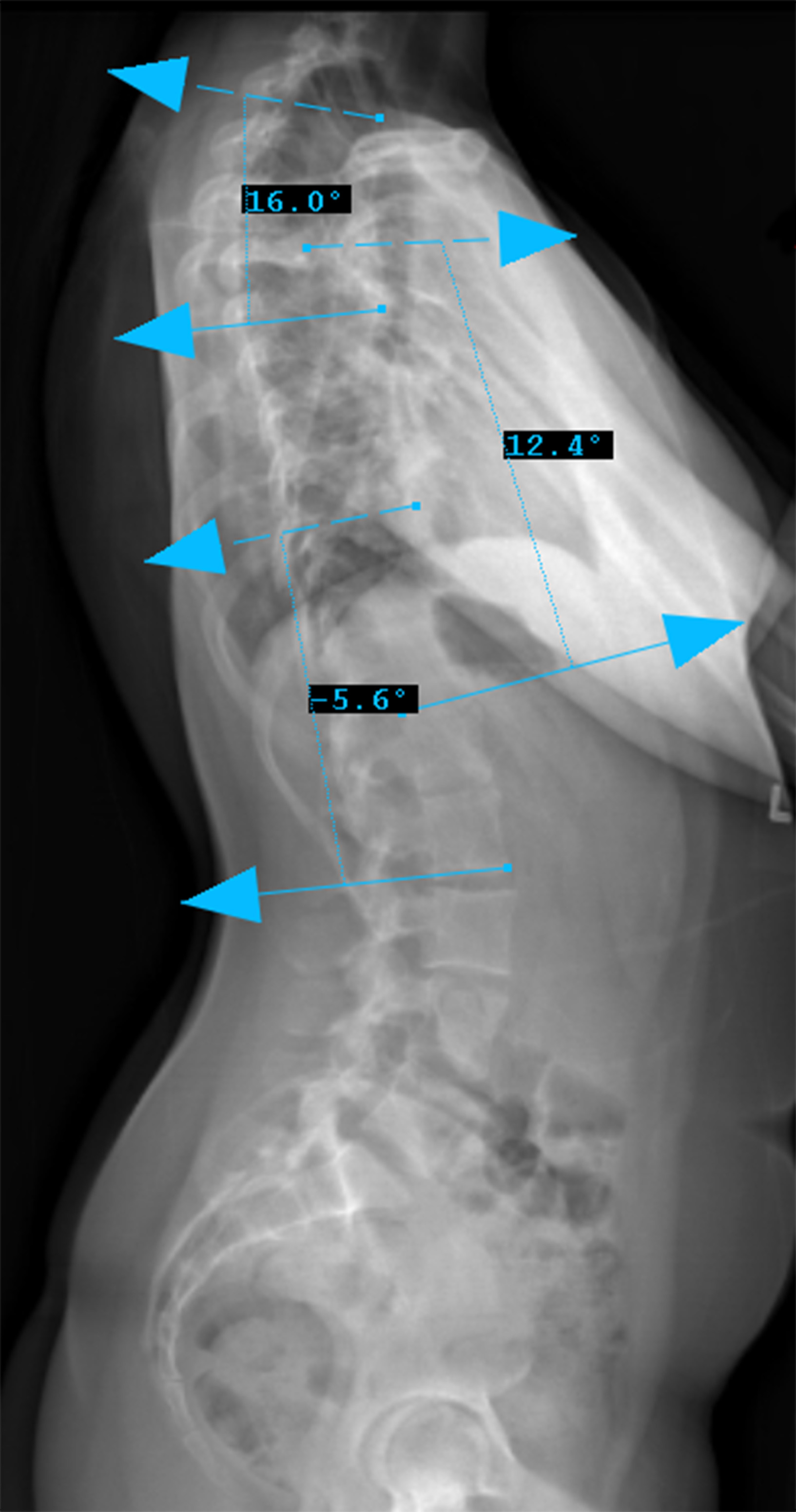 Lenke Class 2BN – Harms Study Group